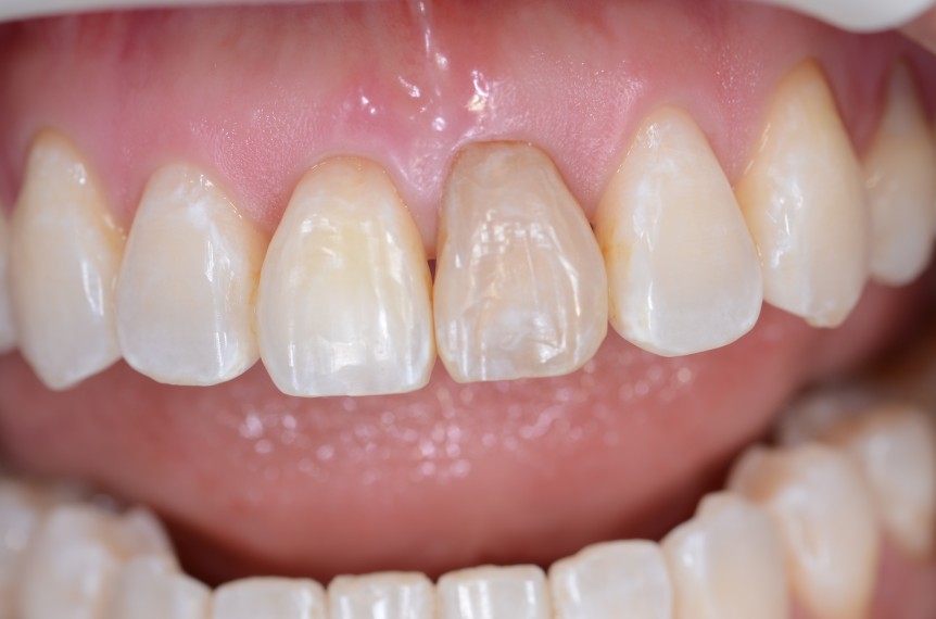 Discolored front teeth - Key West Family Dentistry