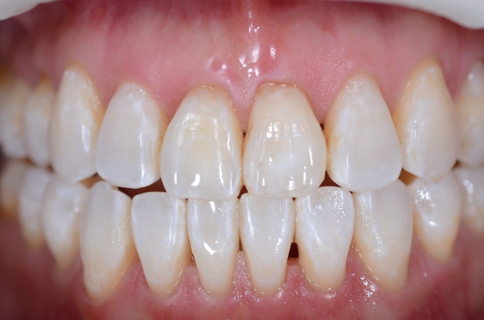 Discolored front teeth - Key West Family Dentistry